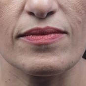 Erbium Laser Skin Resurfacing Service In CA | Beauty Religion