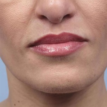 Erbium Laser Skin Resurfacing Service In CA | Beauty Religion